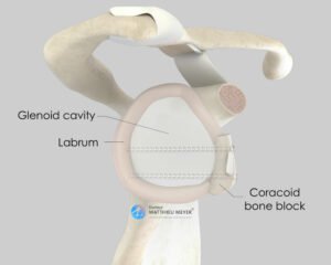 Coracoid Block (Latarjet Procedure) - Doctor Matthieu Meyer