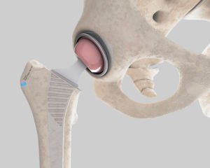 Minimally Invasive Anterior Approach Total Hip Replacement - Doctor ...