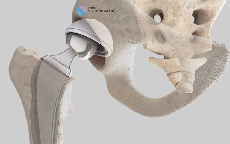 Revision Total Hip Replacement - Doctor Matthieu Meyer