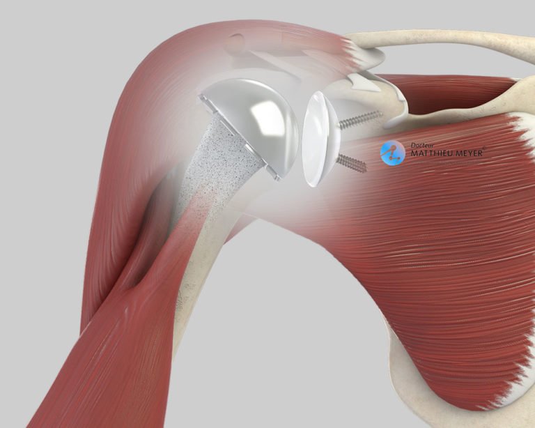 Total Shoulder Replacement - Doctor Matthieu Meyer