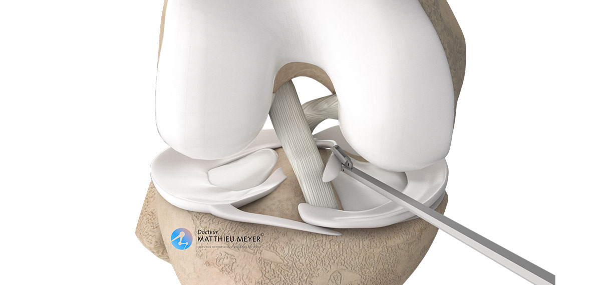 Do MeniScal Lesions Require Surgery? - Doctor Matthieu Meyer