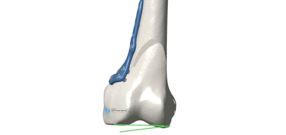 Medial Closing-Wedge Distal Femoral Osteotomy - Doctor Matthieu Meyer