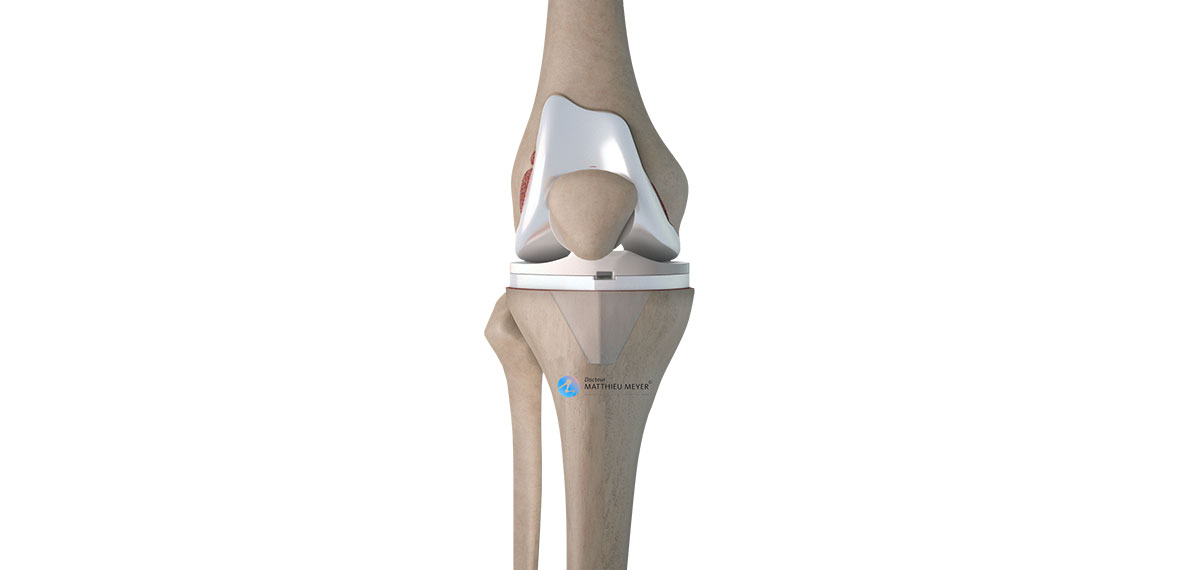 Custom-made total knee prosthesis with 3d CT-Scan planning - Doctor ...