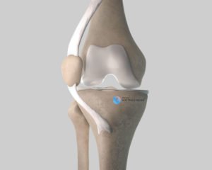 Anterior Tibial Tuberosity Transfer Patella Realignment - Doctor ...