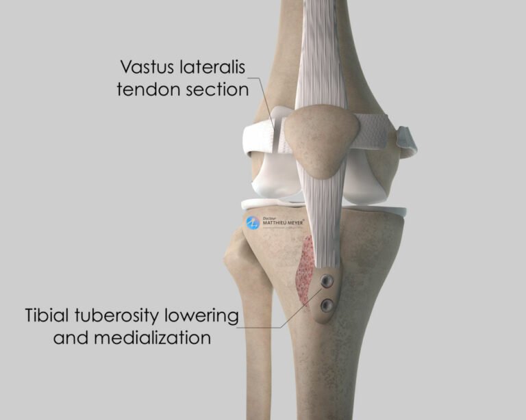 Anterior Tibial Tuberosity Transfer Patella Realignment - Doctor ...