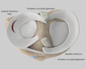 Arthroscopic Meniscal Surgery - Doctor Matthieu Meyer