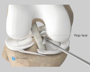 Arthroscopic Meniscal Surgery - Doctor Matthieu Meyer