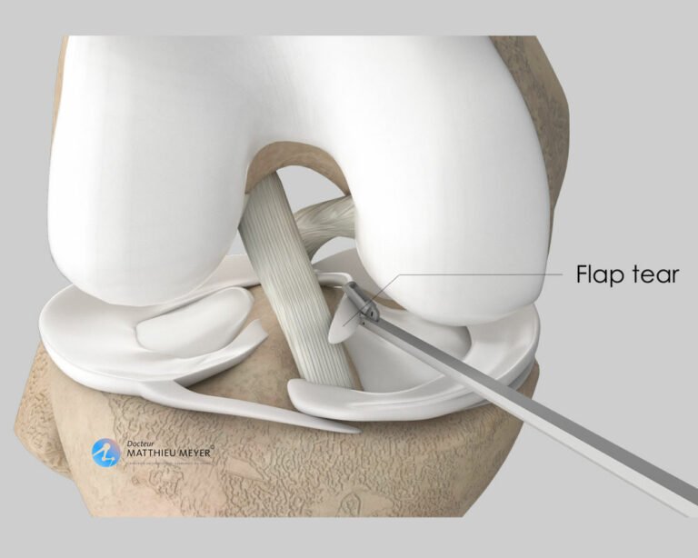 Arthroscopic Meniscal Surgery - Doctor Matthieu Meyer