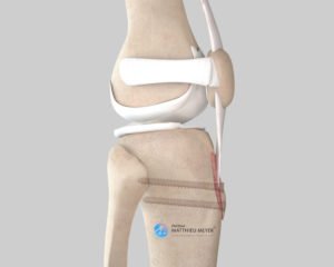 Anterior Tibial Tuberosity Transfer Patella Realignment - Doctor Matthieu Meyer