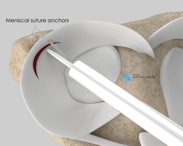 Arthroscopic Meniscal Surgery - Doctor Matthieu Meyer