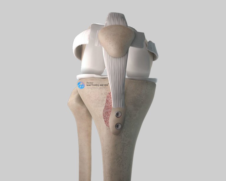 Anterior Tibial Tuberosity Transfer Patella Realignment - Doctor Matthieu Meyer