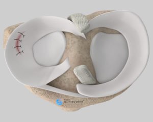 Arthroscopic Meniscal Surgery - Doctor Matthieu Meyer