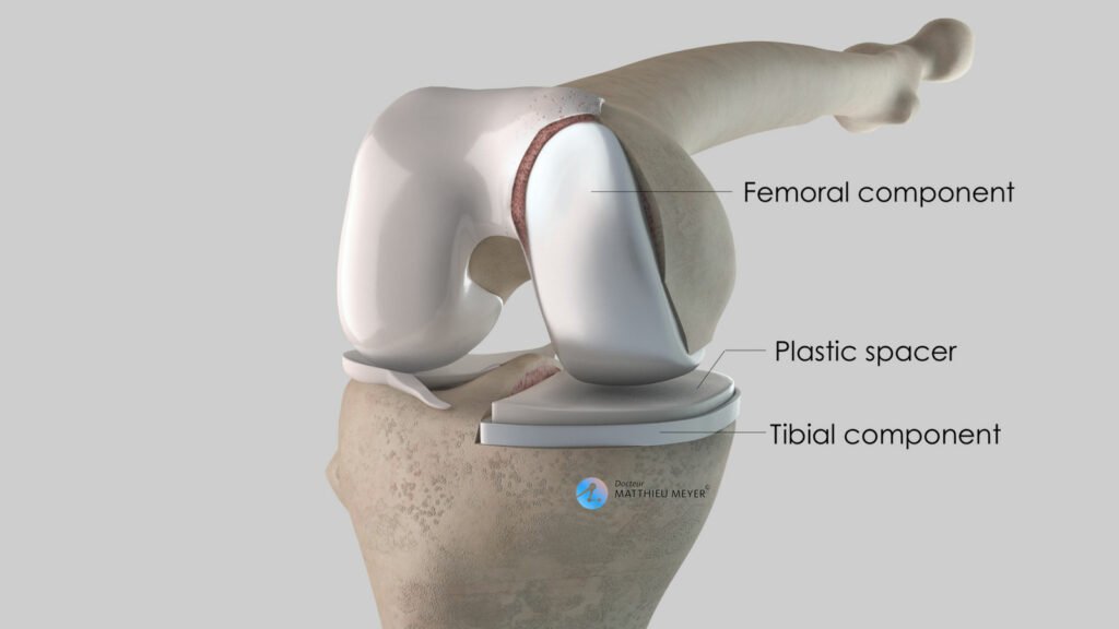 Total Knee Replacement - Doctor Matthieu Meyer