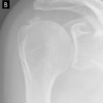 Arthroscopic Removal of Rotator Cuff Calcium Deposits - Doctor Matthieu ...