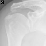 Arthroscopic Removal of Rotator Cuff Calcium Deposits - Doctor Matthieu ...